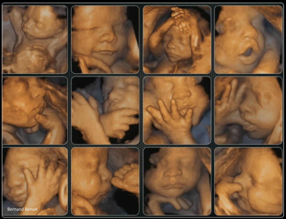 Successful 3D 4D Ultrasound Picture